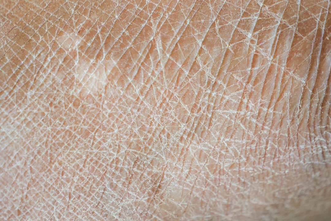 Piel seca y escamosa - Dr Bline